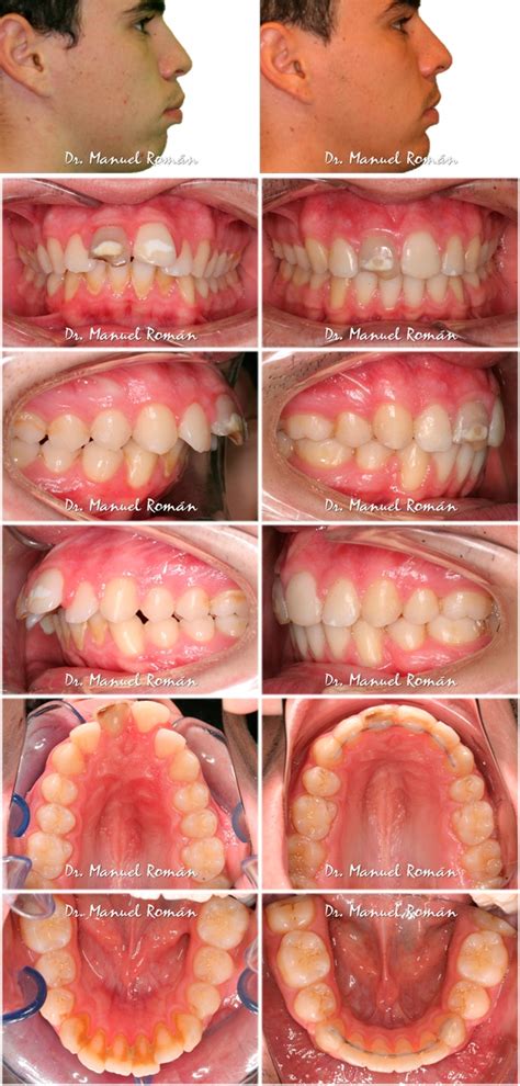 Biprotrusión dental Fotos antes y después con ortodoncia invisible