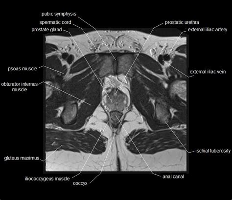 MRI Pelvis Anatomy Free Male Pelvis Axial Anatomy