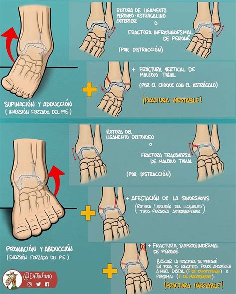 Pin En Fractura Tobillo
