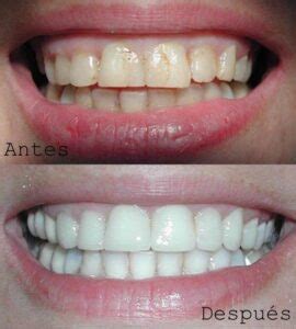 Diseño de Sonrisas Clínica Dental DentArt Las Condes Providencia