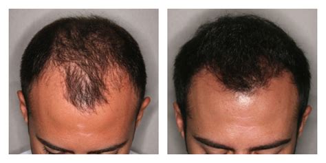 Injerto capilar antes y después Clínica del pelo Precios Opiniones