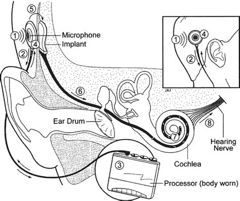 Cochlear Implant Diagram Hot Sex Picture