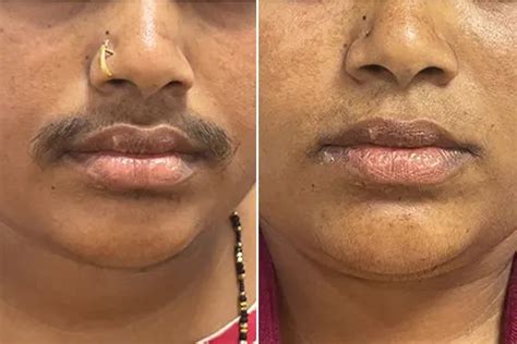 Laser Treatment For Upper Lip Hair Removal Cost On Sale Laseb Fae Ufmg Br