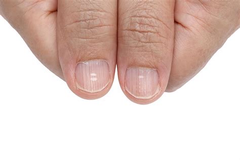 Por qué salen manchas blancas en las uñas Descubre todas las