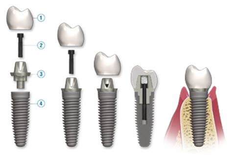 Partes De Un Implante Dental