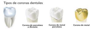 Coronas de porcelana Ventajas desventajas y fotos de antes y después