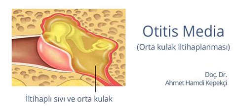 Orta Kulak İltihabı Nedir Doç Dr Ahmet Hamdi Kepekçi