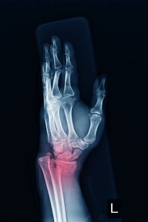 Fracture du poignet Dr Maxime Rousié