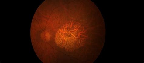 Degeneração macular relacionada à idade DMRI Promácula Dr Nelson
