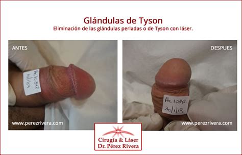 Eliminación Glándulas de Tyson eliminación Pápulas Perladas en Pene