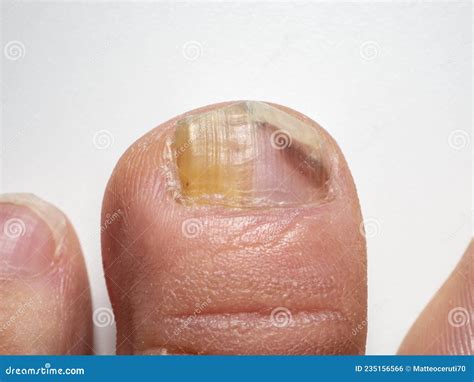 Infecciones De Uñas Causadas Por Hongos Como Onicomicosis También