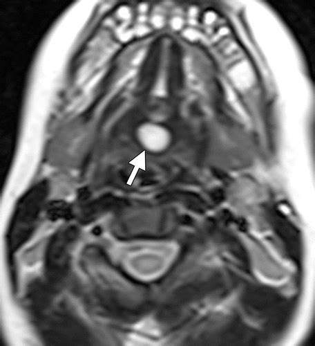 Thyroglossal Duct Cyst Mri