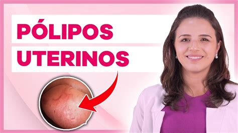 O que é Polipo No Utero 2023 Resolvido Ame Jumelle