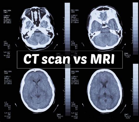 MRI And CT Scan Comparison And Their Roles In Personal Injury Cases