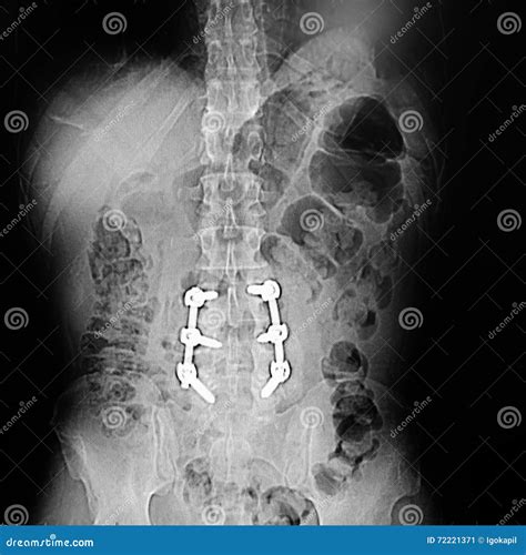 Patolog A De Las V Rtebras De La Espina Dorsal Lumbar De La Radiograf A