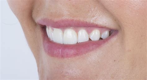 diseño de sonrisas Clínica Dental Blay Monzo