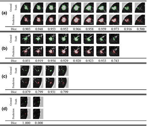 segmentation results of lung nodules with different sizes by 3d res download scientific diagram