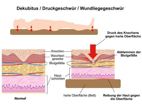 Modernes Wundmanagement Patientenbericht Dekubitus PraNatu