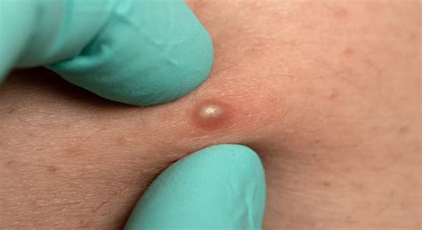 Foliculite o que é causas e tratamento Saudelogia