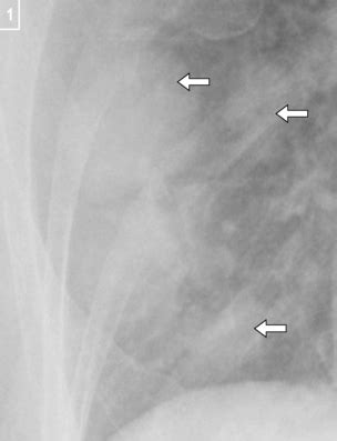 Lung Metastases Multiple Pulmonary Nodules Radiology Key