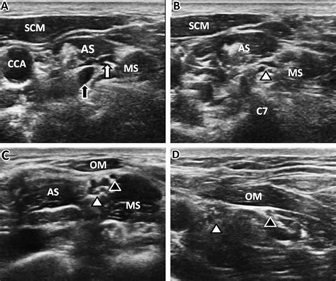 Supraclavicular Nerve Block