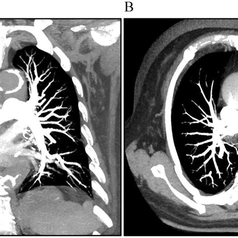 PDF An Optimized Test Bolus For Computed Tomography Pulmonary