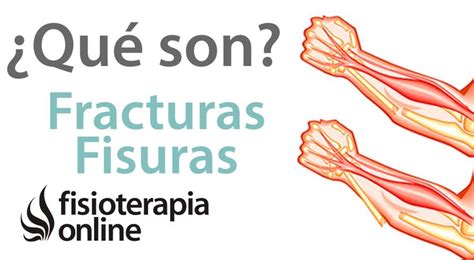 Fractura y fisura Qué es y cuáles son sus fases de curación