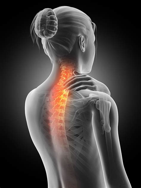 Pinched Nerve Cervical Radiculopathy Ohio State Medical