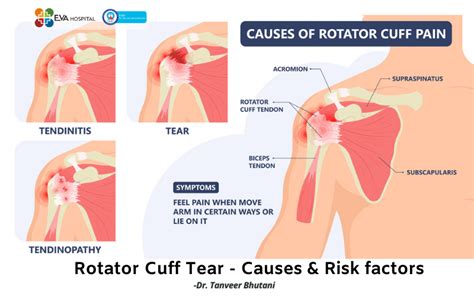 Risk Factors And Precautions For Rotator Cuff Disorders Ask The Nurse