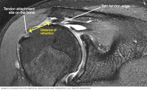 Rotator Cuff Injury Diagnosis And Treatment Mayo Clinic