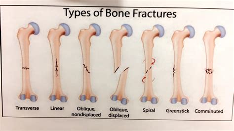 Types Of Bone Fractures Guide R Coolguides