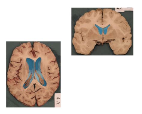 Basal Ganglia Id Flashcards Quizlet