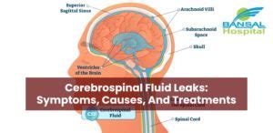 Cerebrospinal Fluid Leaks Symptoms Causes And Treatments