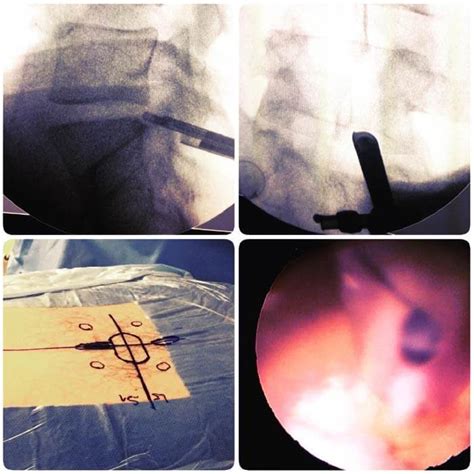 Endoscopia Lombar Dr Jonas Lenzi