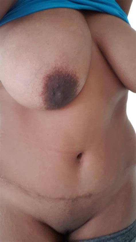 Nsfw First Time Posting Here S My Scar Did A Tummy Tuck Years Ago