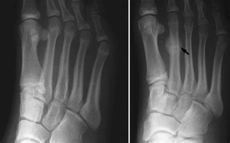 Metatarsal Bone Fracture