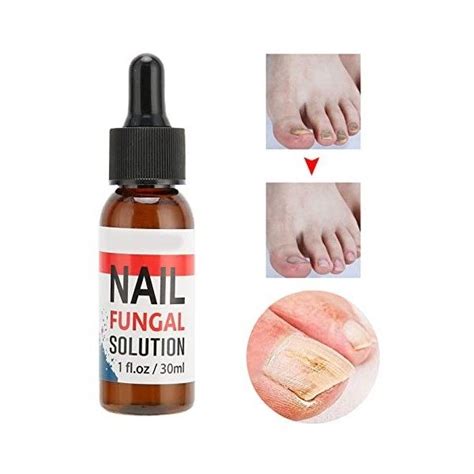 Traitement Des Mycoses Des Ongles Renouvellement Doux Des Ongles F