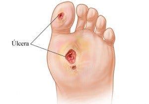 Fisioterapia y prevención en el pie diabético FisioOnline