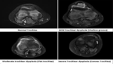 The Oswestry Bristol Classification Of Trochlear Dysplasia