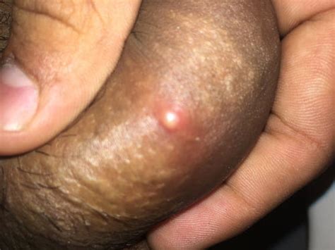 Grano En El Pene Resuelto
