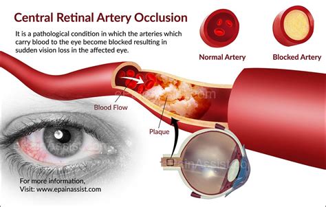 Curso ocular oclusão da artéria retiniana Olho Saúde 2024