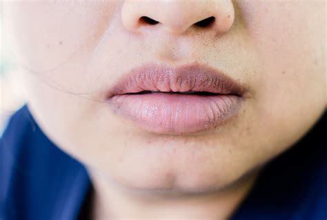 Why Do I Have Dark Spots Under My Lips Lipstutorial Org