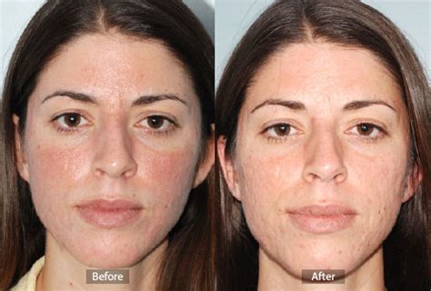 Fraxel Acne Scars Before And After