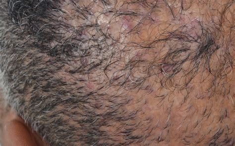 Foliculite O Que Tipos Causas Sintomas Tratamento