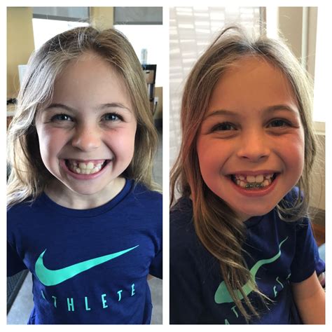 Before And After Braces 100 Frases De Amor Frases