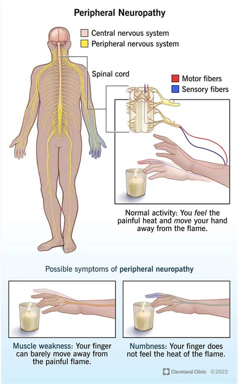 Finding Your Feet With Peripheral Neuropathy Neurological